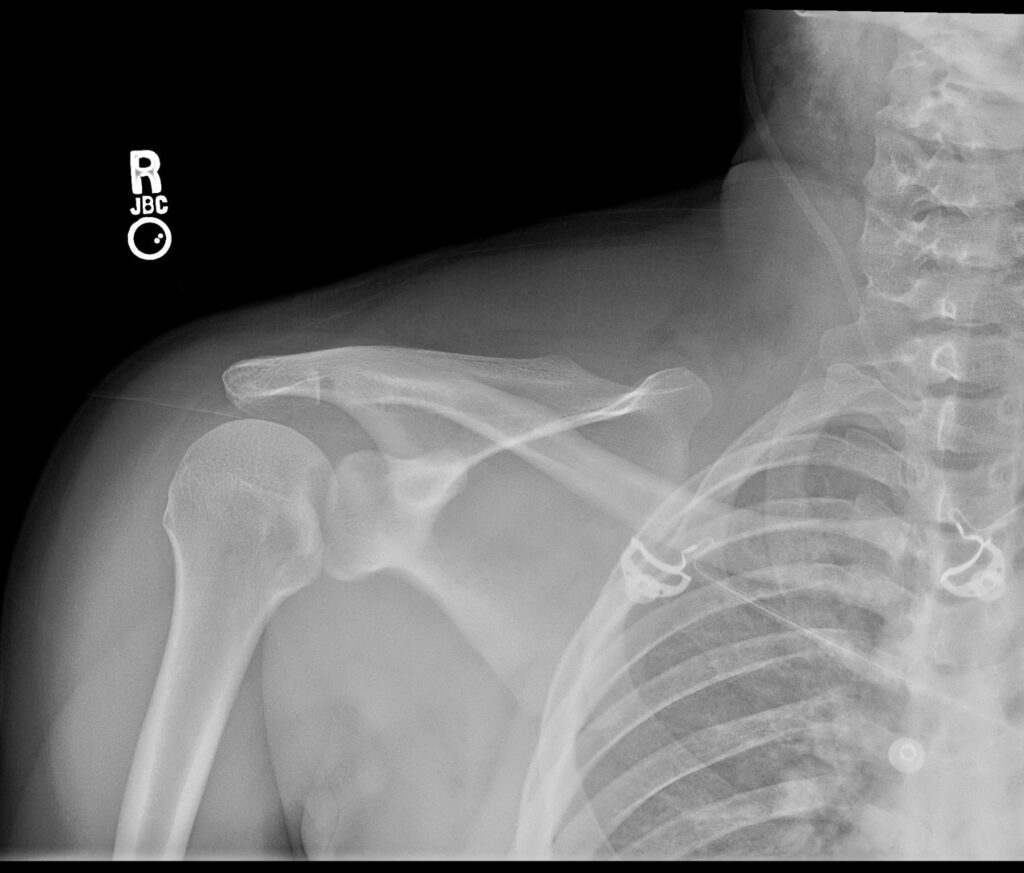 Posterior Shoulder Dislocation | Resus