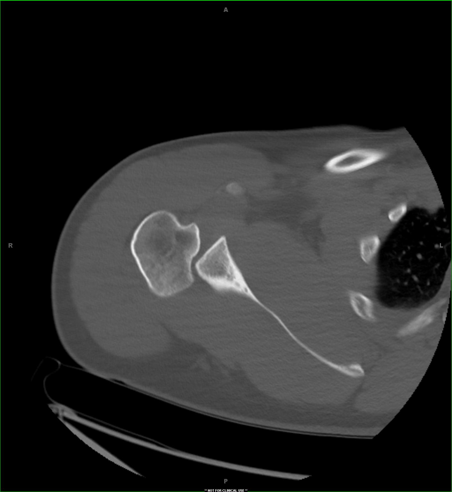 Posterior Shoulder Dislocation | Resus