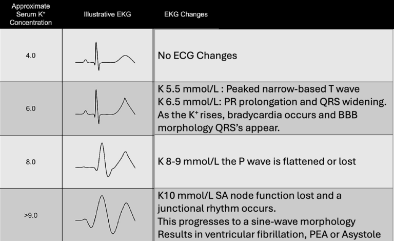 Hyperkalaemia: Can the ECG predict when to treat? | Resus