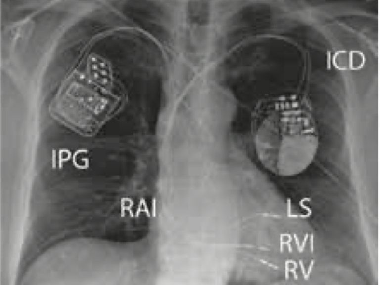 Is this a pacemaker malfunction? | Resus