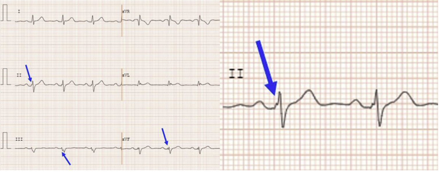 The Fragmented QRS | Emergency Medical Education