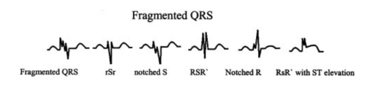 The Fragmented QRS | Emergency Medical Education