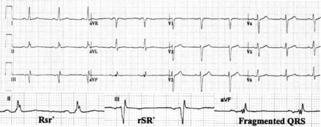 The Fragmented QRS | Emergency Medical Education