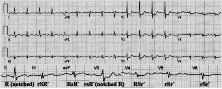 The Fragmented QRS | Emergency Medical Education