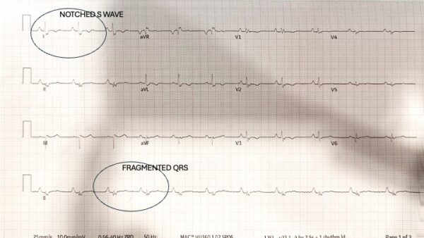 The Fragmented QRS | Emergency Medical Education