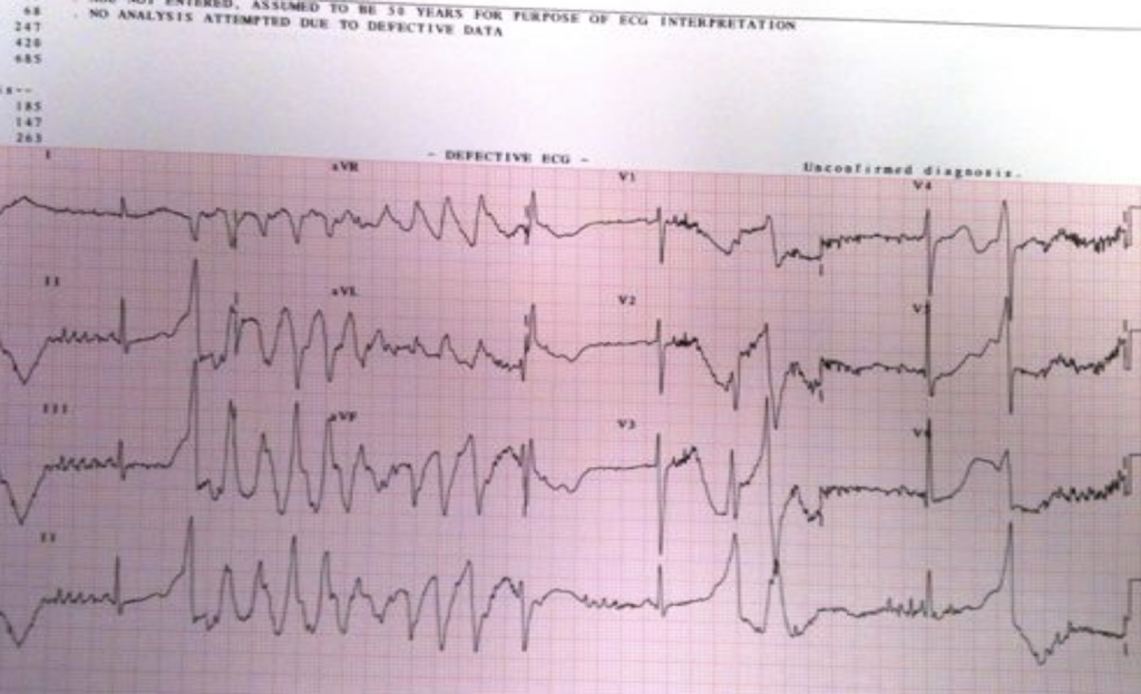 Is this Polymorphic VT? | Resus