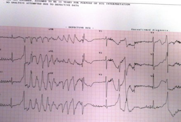 Is Ventricular Bigeminy Benign? Which Patients Need treatment? | Resus