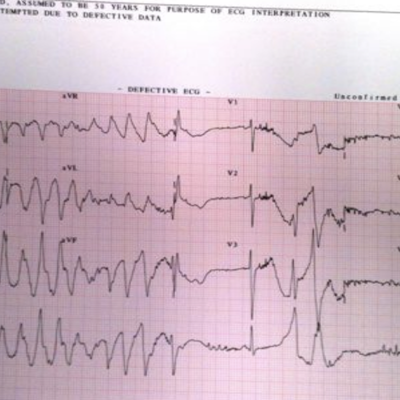 Bell's Phenomenon | Emergency Medicine Education | Resus